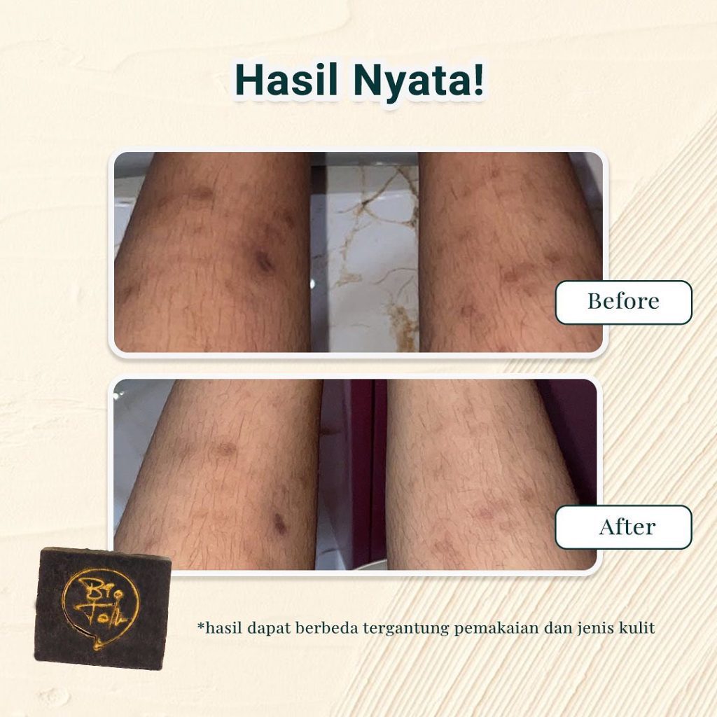 Coffee Scrub Memudarkan Bekas Luka | Biotalk