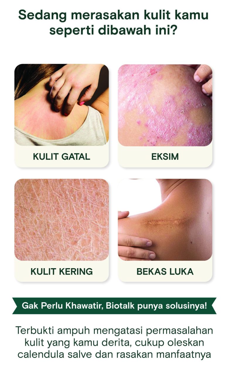 Natural Calendula Salve untuk Eksim & Psoriasis | Biotalk