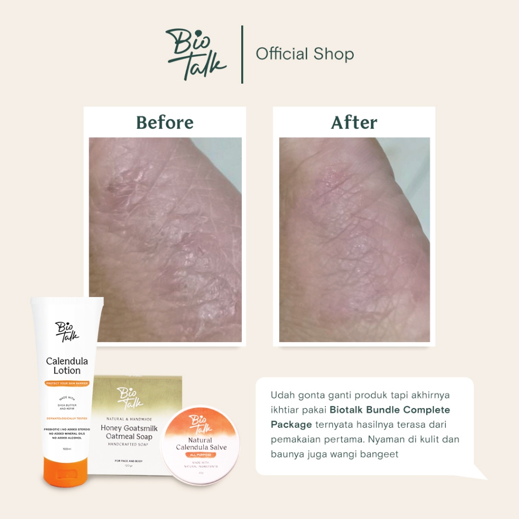 Natural Calendula Salve untuk Eksim & Psoriasis | Biotalk
