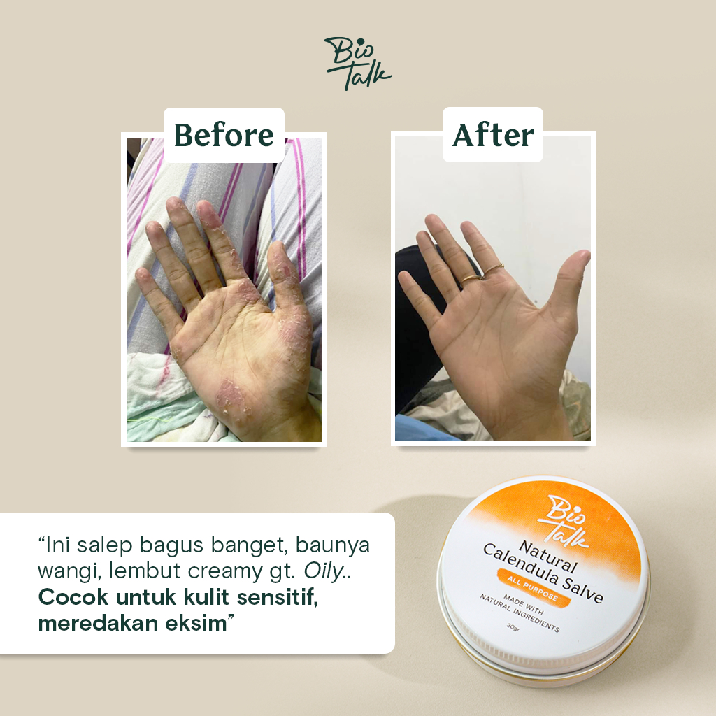 Natural Calendula Salve untuk Eksim & Psoriasis | Biotalk