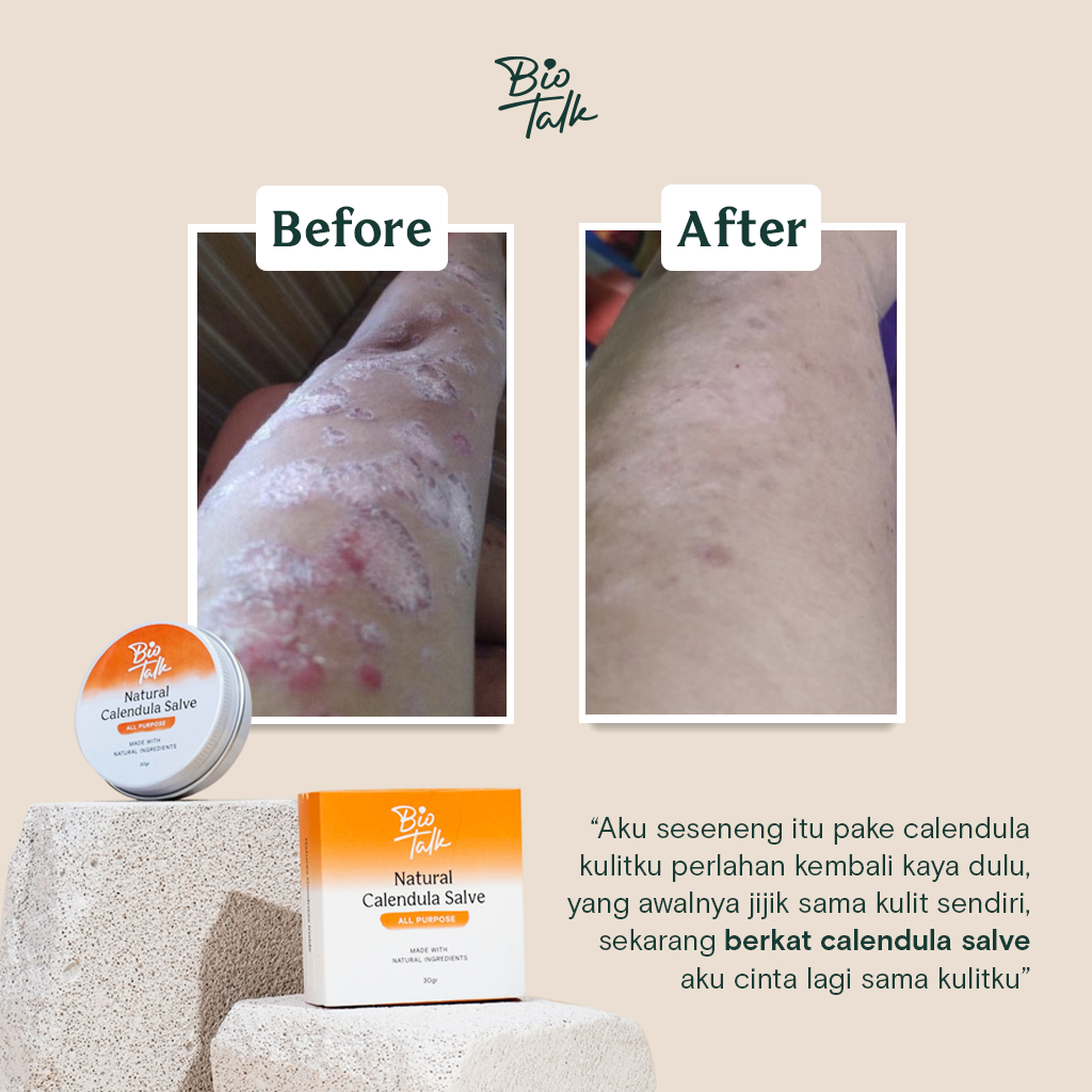 Natural Calendula Salve untuk Eksim & Psoriasis | Biotalk